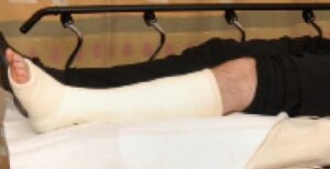 Plaster Cast | NHS Lanarkshire