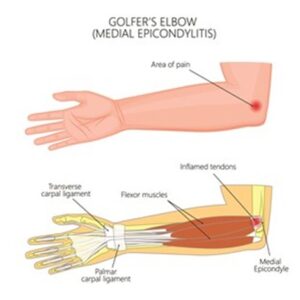 Golfer’s Elbow - NHS Lanarkshire