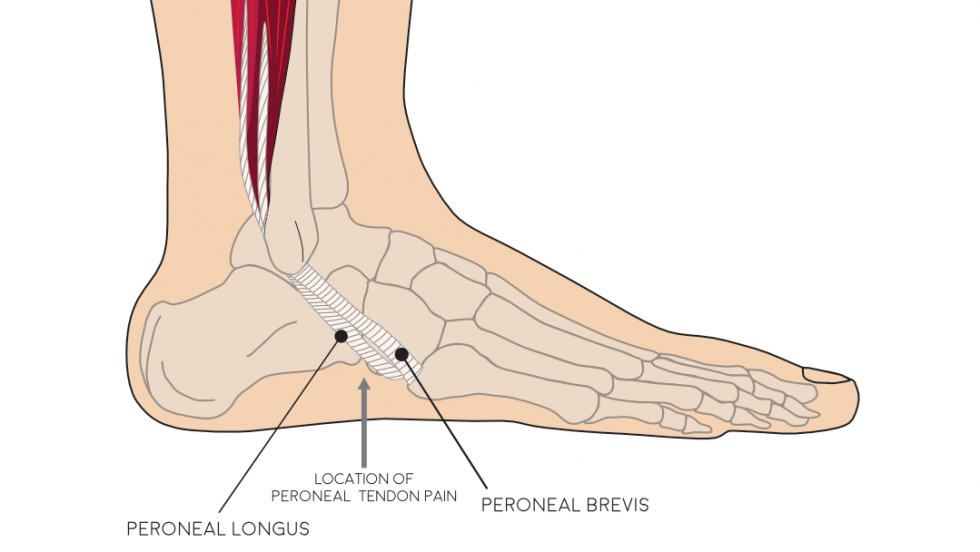 Peroneal Tendinopathy | NHS Lanarkshire