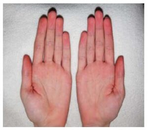 Syphilis | NHS Lanarkshire