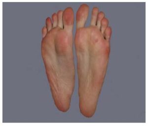 Syphilis | NHS Lanarkshire