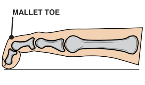 Lesser toe deformities | NHS Lanarkshire