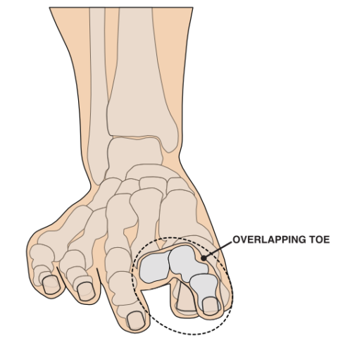 Lesser toe deformities | NHS Lanarkshire