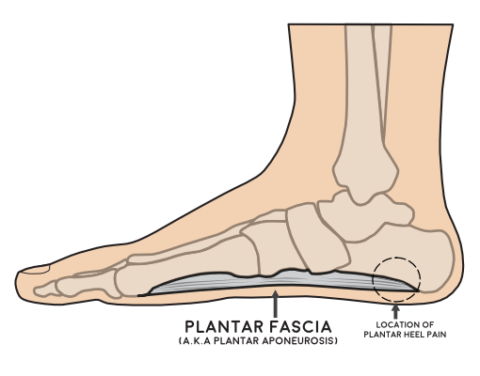 Plantar Heel Pain | NHS Lanarkshire