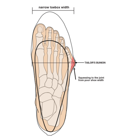 Tailor’s Bunion (Bunionette) | NHS Lanarkshire