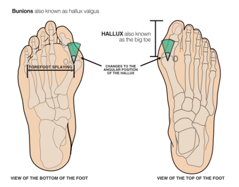 Hallux Valgus (Bunions) | NHS Lanarkshire