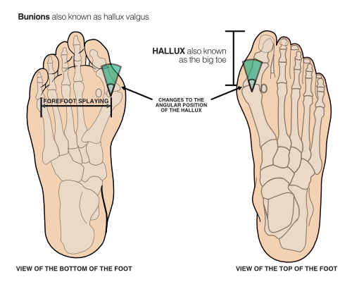 Hallux Valgus Bunions NHS Lanarkshire Hallux Valgus Bunions NHS Lanarkshire