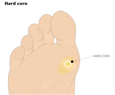 Hard Skin and Corns | NHS Lanarkshire