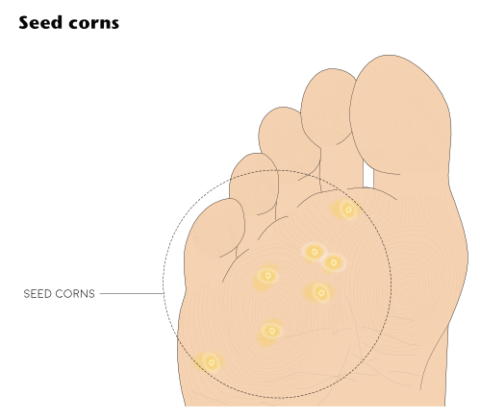 Hard Skin and Corns | NHS Lanarkshire