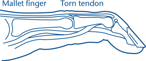 Discharge advice following Mallet Finger injury | NHS Lanarkshire