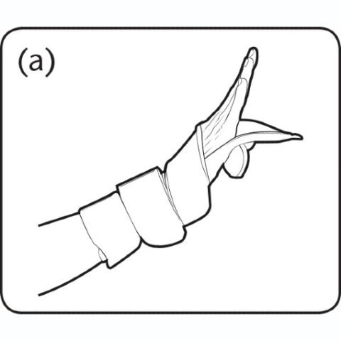 Extensor Tendon Injuries | NHS Lanarkshire