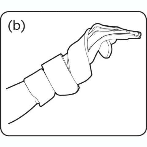Extensor Tendon Injuries | NHS Lanarkshire