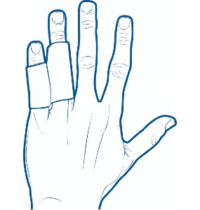 Discharge advice following 5th Metacarpal Fracture | NHS Lanarkshire