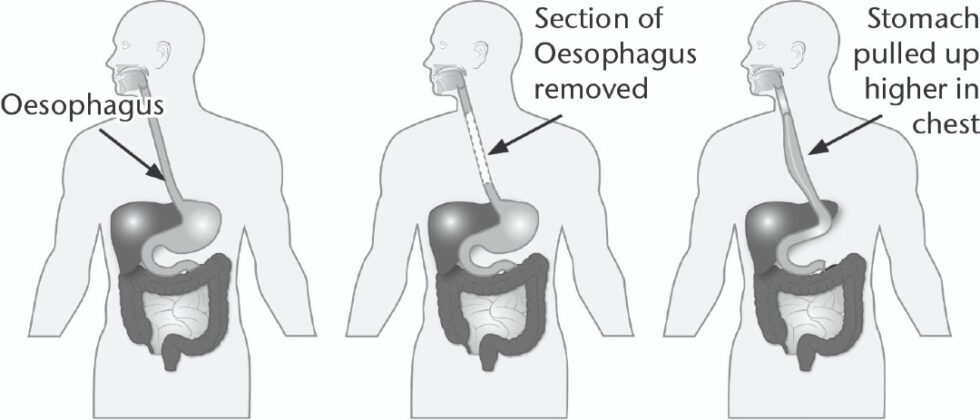 Dietary advice following an Oesophagectomy or Gastrectomy | NHS Lanarkshire
