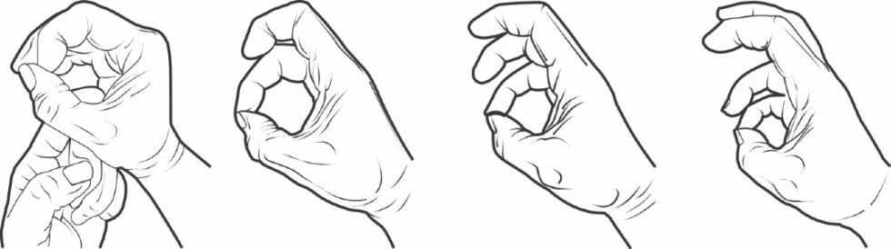 Osteoarthritis of the base of the thumb | NHS Lanarkshire