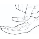Information on Ulnar Collateral Ligament repairs to the Thumb | NHS ...