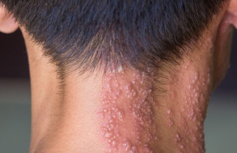 Shingles Vaccination Programme - NHS Lanarkshire